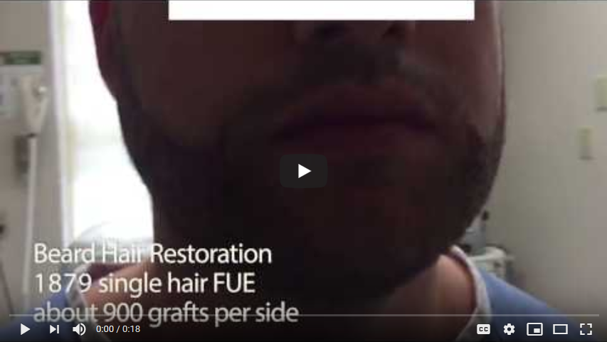 Toronto Beard Transplant | Dr.Robert Jones