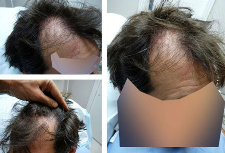 Case Study - Before and After hairline repair | Dr Robert Jones