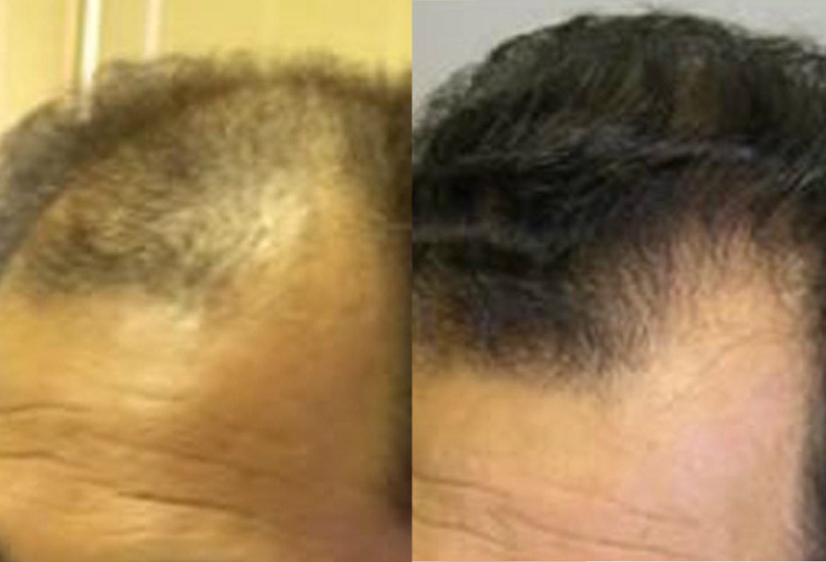 Hair Transplant Results - Toronto Hair Transplant Surgeons