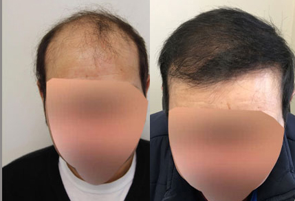 Hair Transplant Results - Toronto Hair Transplant Surgeons