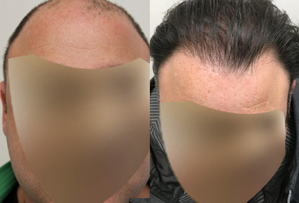 Hair Transplant Results - Toronto Hair Transplant Surgeons