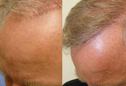 Hair Transplant Results - Toronto Hair Transplant Surgeons