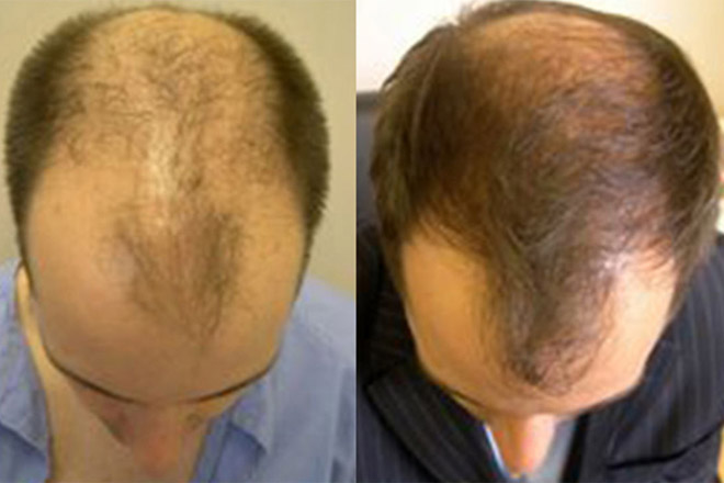 Strip Harvesting Hair Transplant Results | Toronto Hair Transplant Surgeons