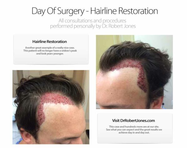Hairline Restoration in Toronto - Toronto Hair Transplant Surgeons