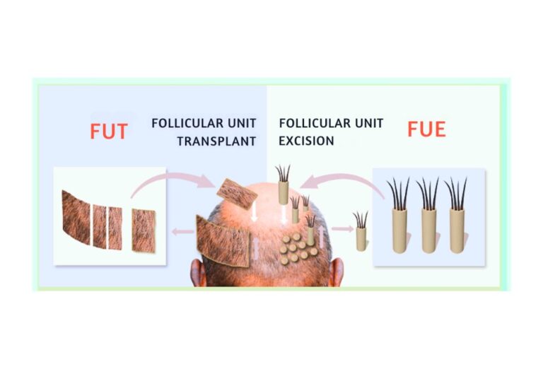 FUE vs FUT Hair Transplant: Which is Best for You - THTS